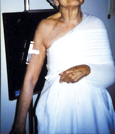 Prothèse Aequalis-Fracture : technique chirugicale