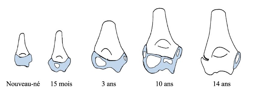 Les fractures du coude de l'enfant et leurs sequelles