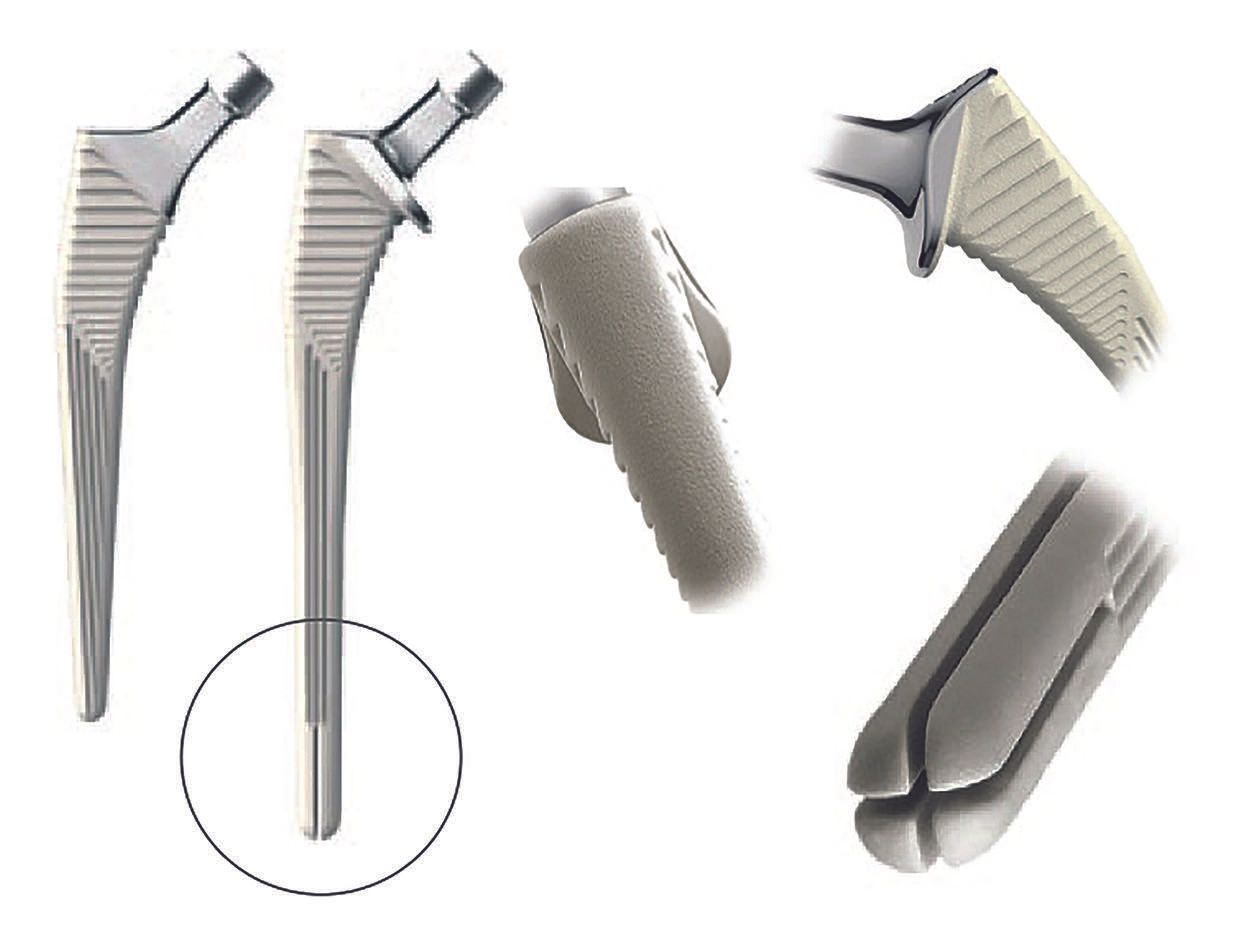 Les dix points clés de la révision fémorale par prothèse de révision ...