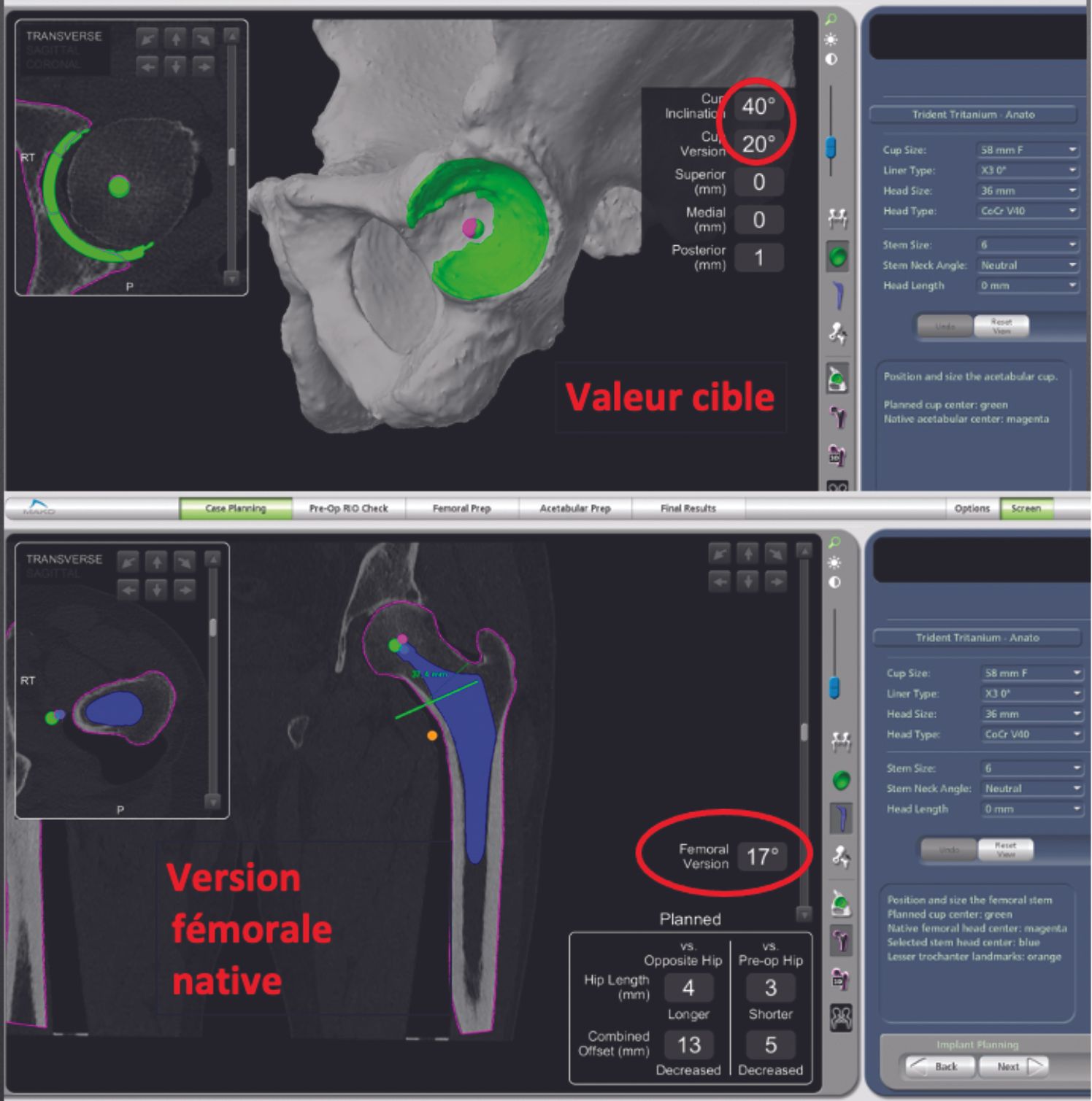 Prothèse totale de hanche assistée par robot MAKO : planification 3D ...