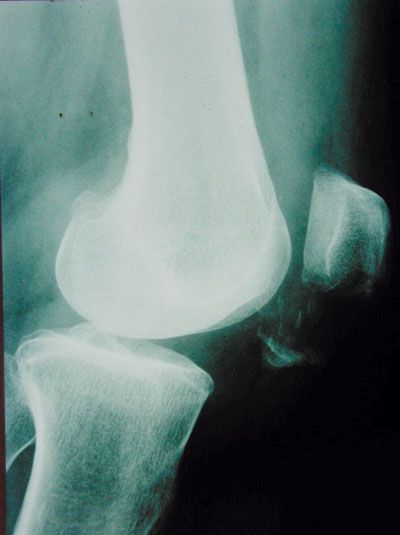 Les fractures de rotule