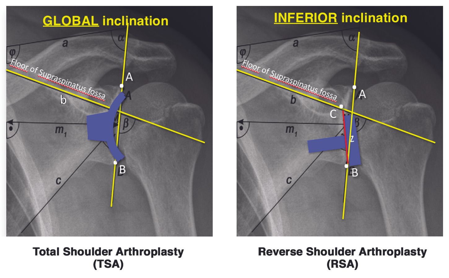 L’angle RSA : une nouvelle mesure de l’inclinaison glénoïdienne pour ...