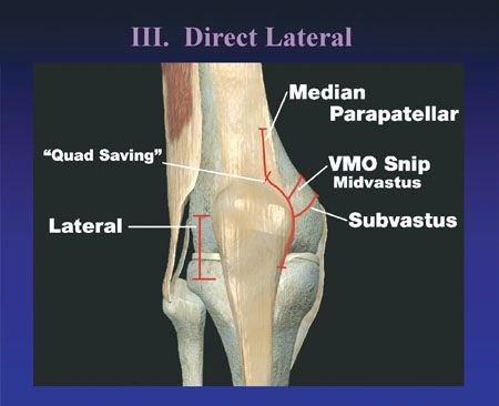 Arthroplastie totale du genou par voie latérale : un abord mini-invasif ...