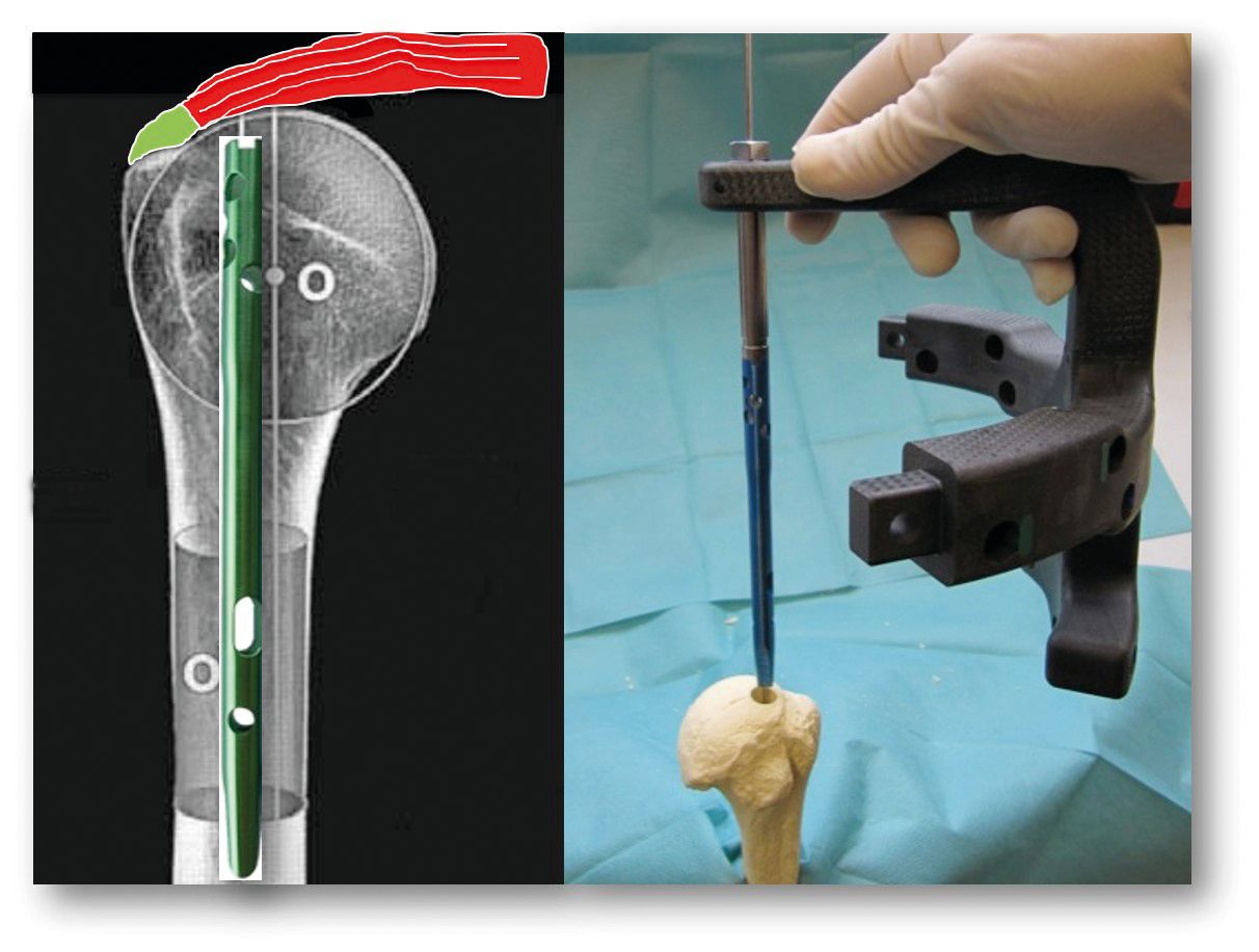 Fractures déplacées du col chirurgical de l’humérus : Classification et ...