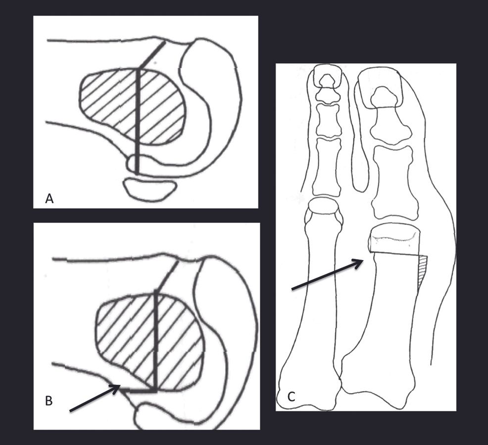 L’ostéotomie épiphyso-métaphysaire distale en chevron dans le ...