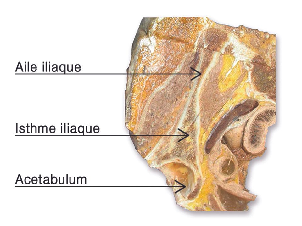 Le Cotyle Integra : un cotyle double mobilité de reconstruction Concept, technique chirurgicale ...
