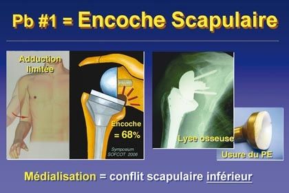 Intérêt de la latéralisation osseuse dans la prothèse d'épaule inversée ...