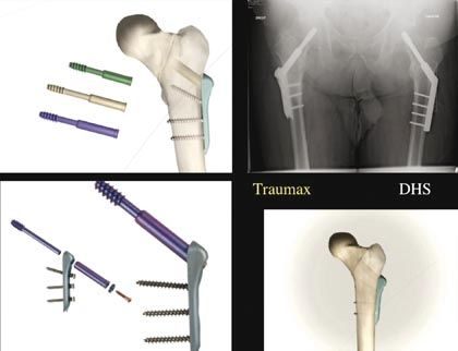 La vis plaque "Traumax" pour l'ostéosynthèse percutannée des fractures ...