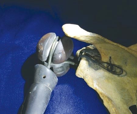 Restaurer l'anatomie de la glène prothétique des prothèses anatomiques ...