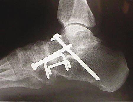 Notre expérience de la triple arthrodèse de l'arrière-pied