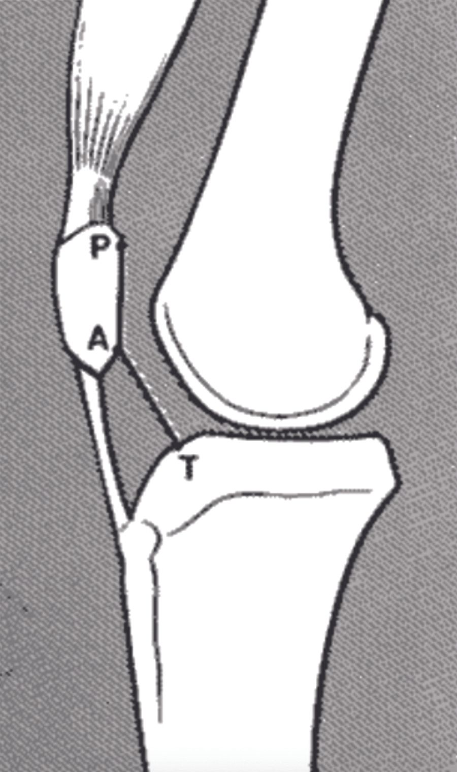 Patella Infera sur Prothèse Totale du genou : Technique combinée d ...