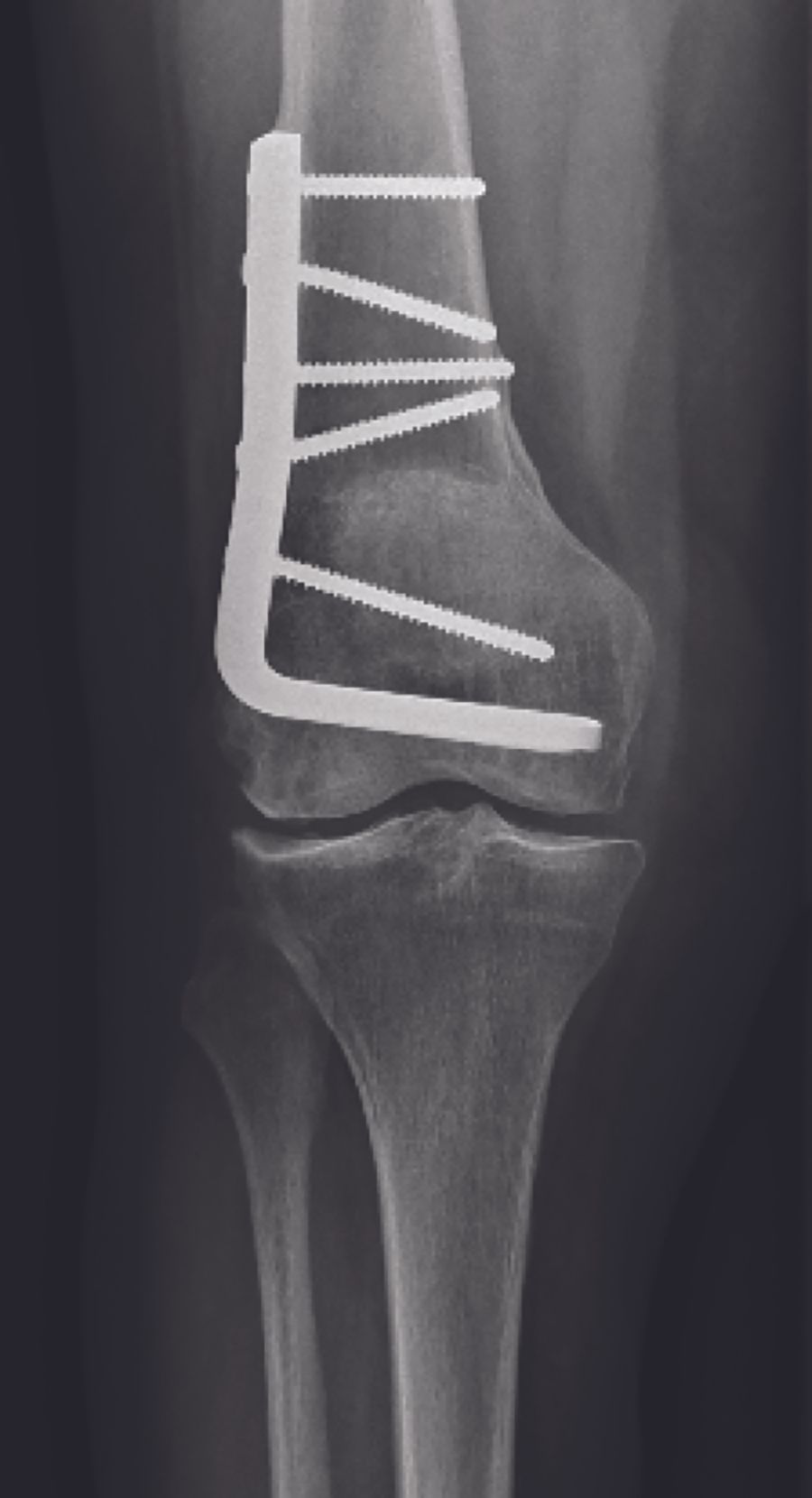 Prothèse totale du genou après ostéotomie fémorale de varisation ...