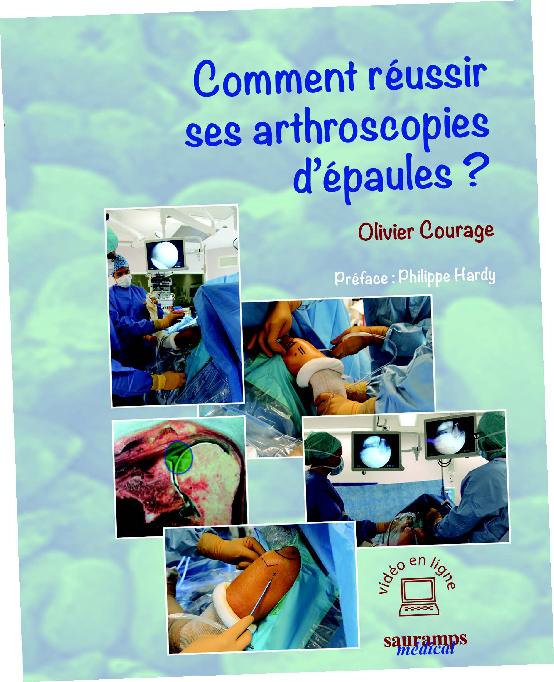 Comment réussir ses arthroscopies d’épaules
