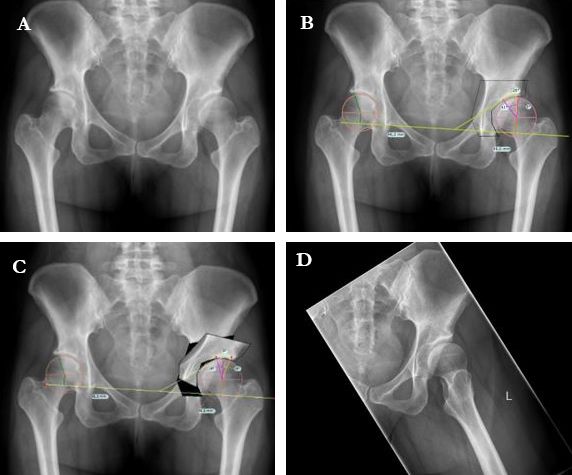 L’ostéotomie périacétabulaire (OPA) mini-invasive pour le traitement de ...