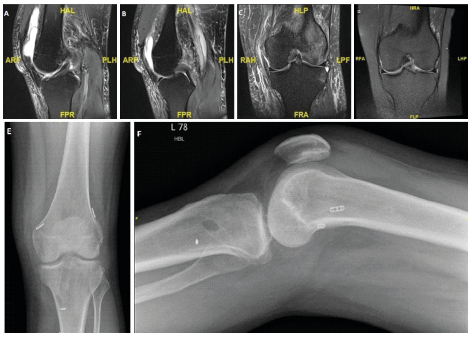 Luxation du genou diagnostic et prise en charge thérapeutique