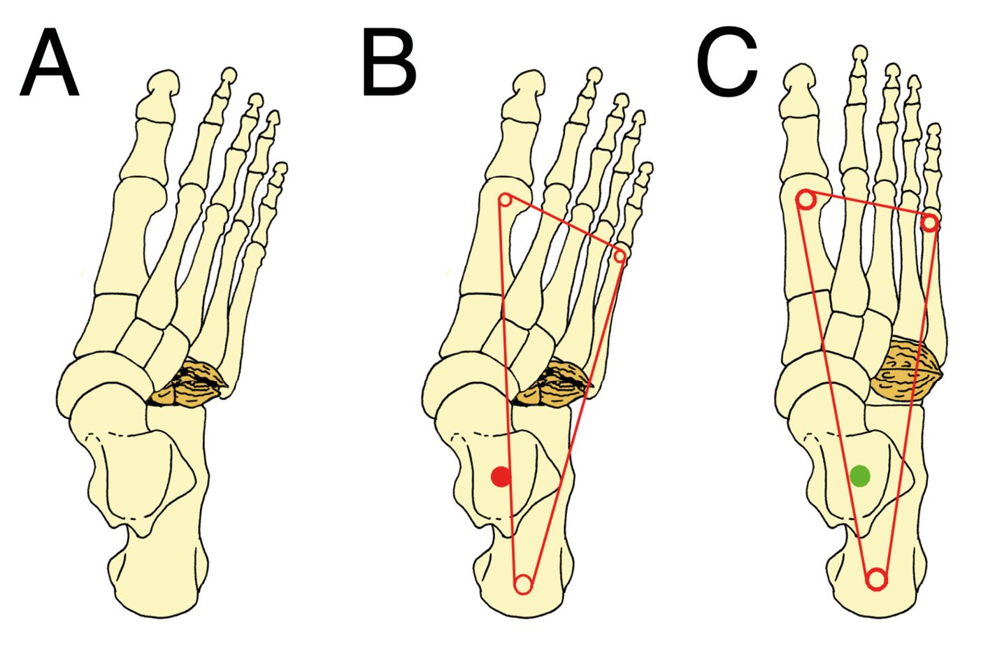 Grands principes de prise en charge chirurgicale des fractures des os ...