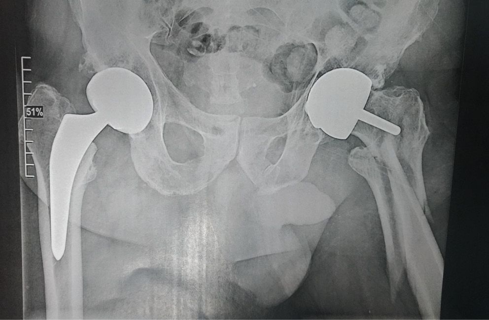 Intérêt du resurfaçage de hanche dans la coxarthrose du sportif