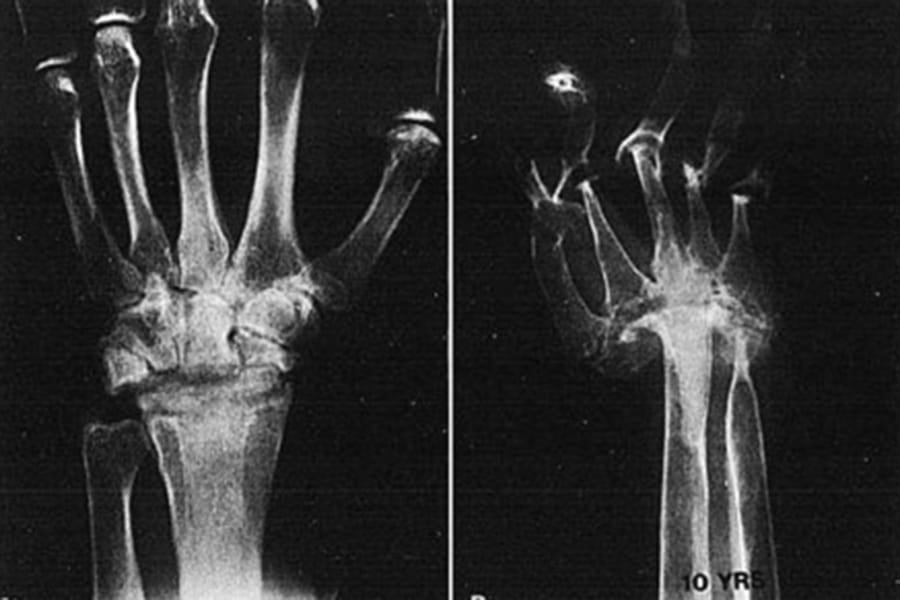 Les arthroplasties de poignet : historique et perspectives