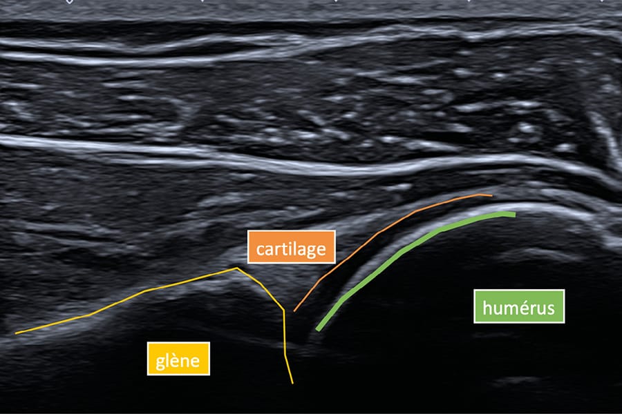 La place de l'échographie dans le diagnostic de la capsulite rétractile