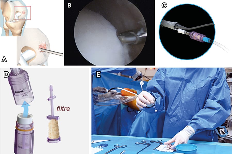 Greffe cartilagineuse autologue morcelée sous arthroscopie